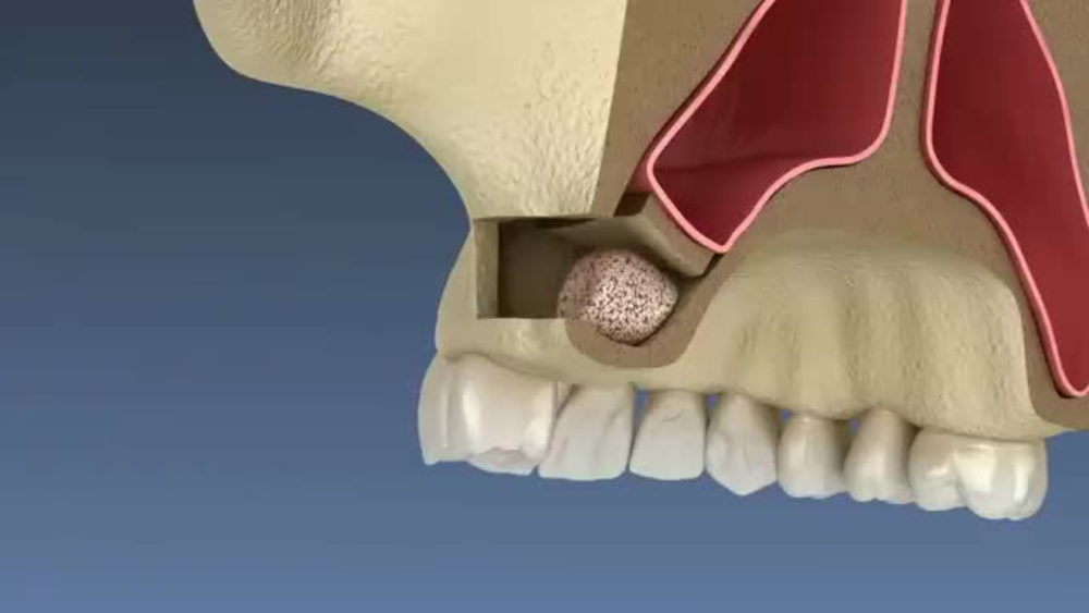 3d dental animation 3d surgical explainer video 3d medical animation ...