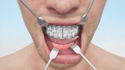 3D Medical Animation Surgery Scientific Animation Medical Device ...