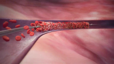 Professional medical 3d animation, surgical, biological animation in 3D ...