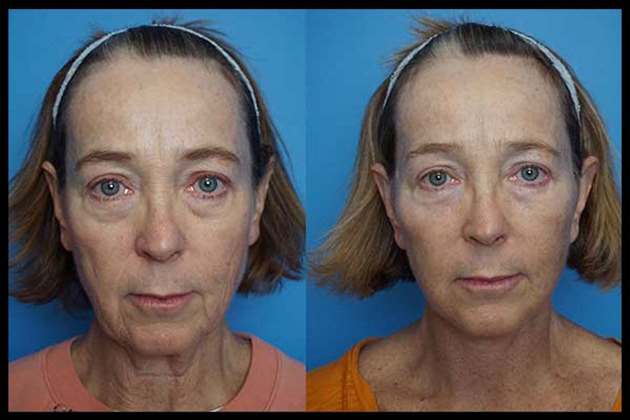 Face Lift Procedure & Treatment | Treatments | UW Health