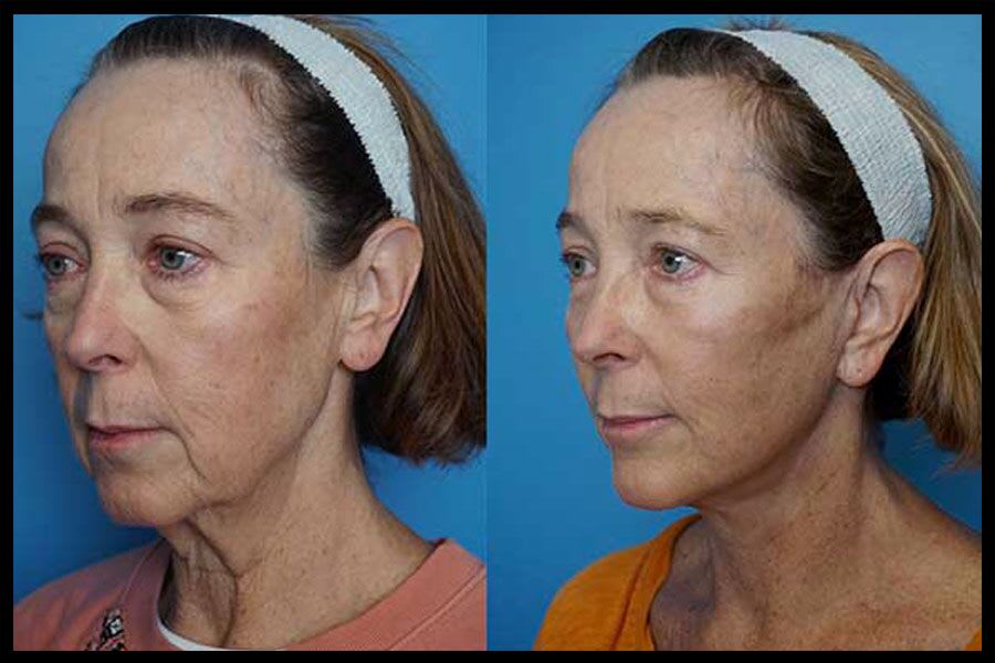 Face Lift Procedure & Treatment | Treatments | UW Health