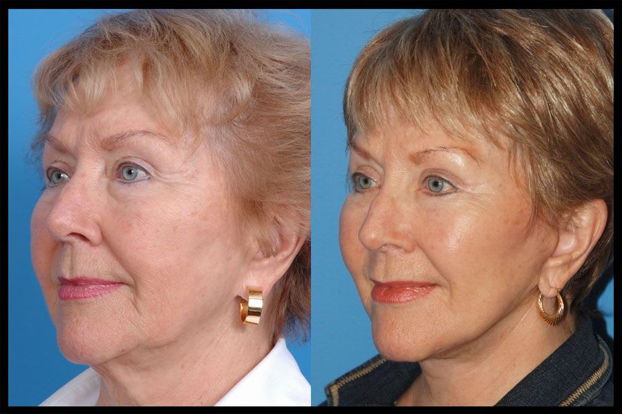 Face Lift Procedure & Treatment | Treatments | UW Health