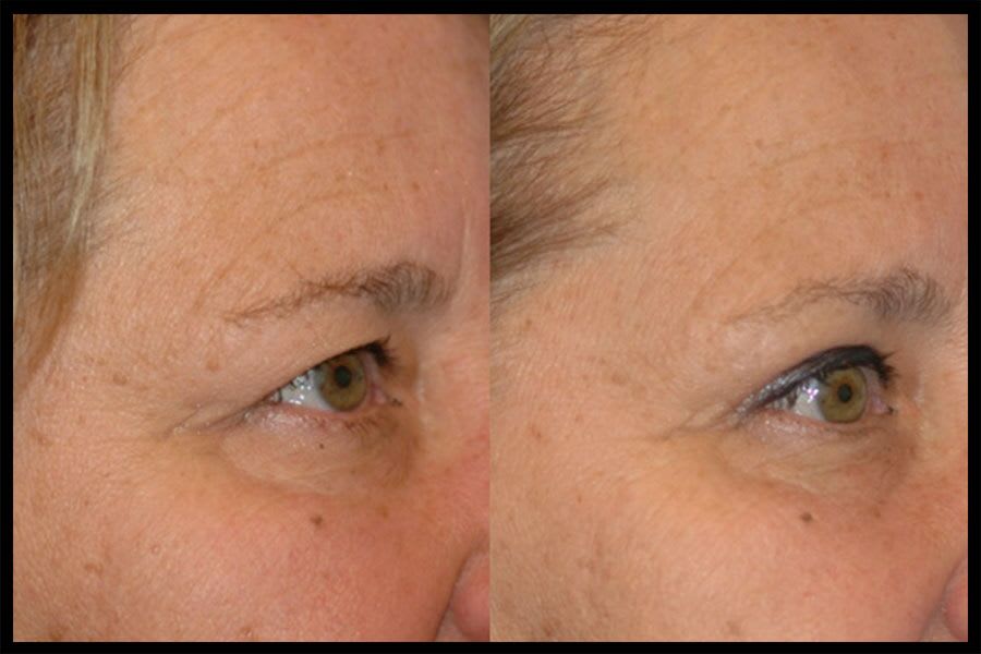 Blepharoplasty (Eyelid Surgery) Treatment | Treatments | UW Health