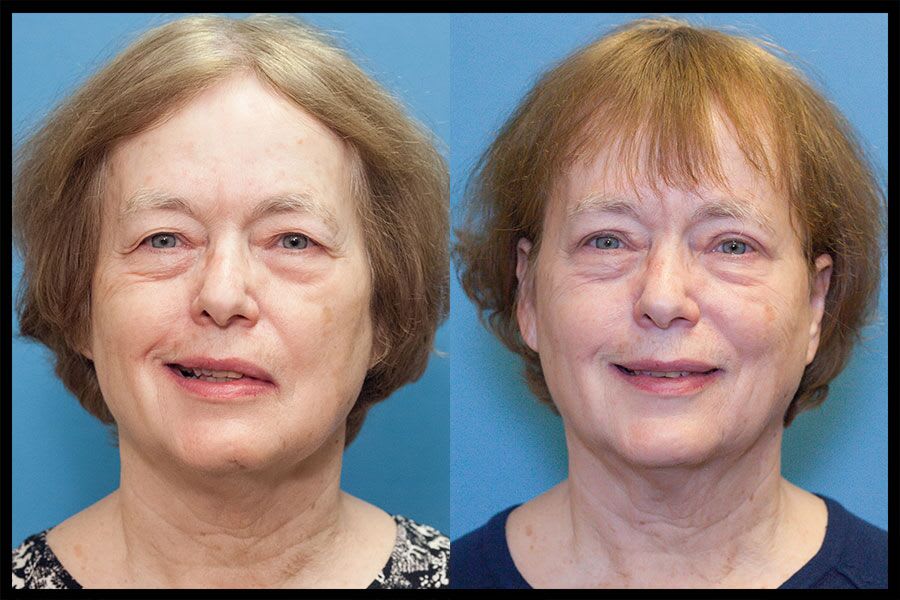 Facial Nerve Paralysis Treatment | Conditions | UW Health