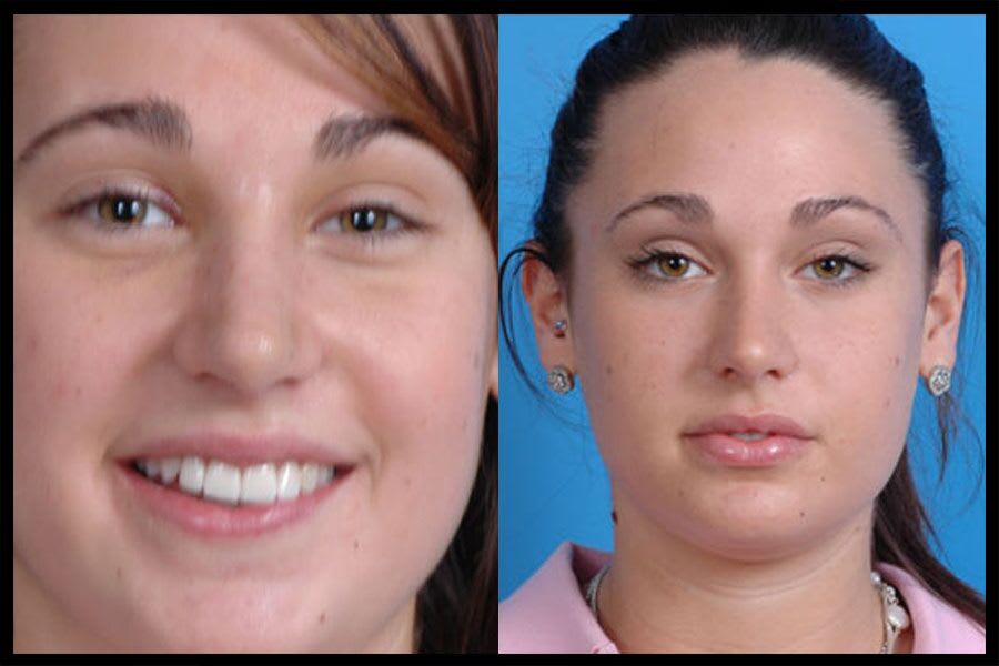 Rhinoplasty Procedure & Treatment | Treatments | UW Health