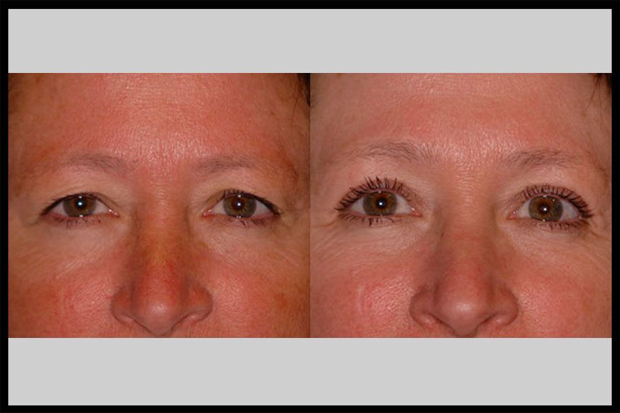 Blepharoplasty (Eyelid Surgery) Treatment | Treatments | UW Health