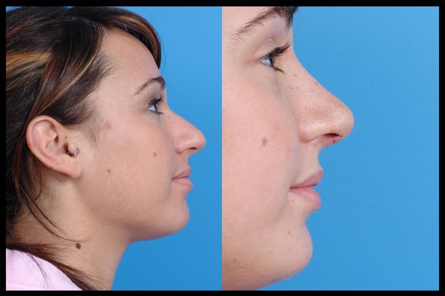 Rhinoplasty Procedure & Treatment | Treatments | UW Health
