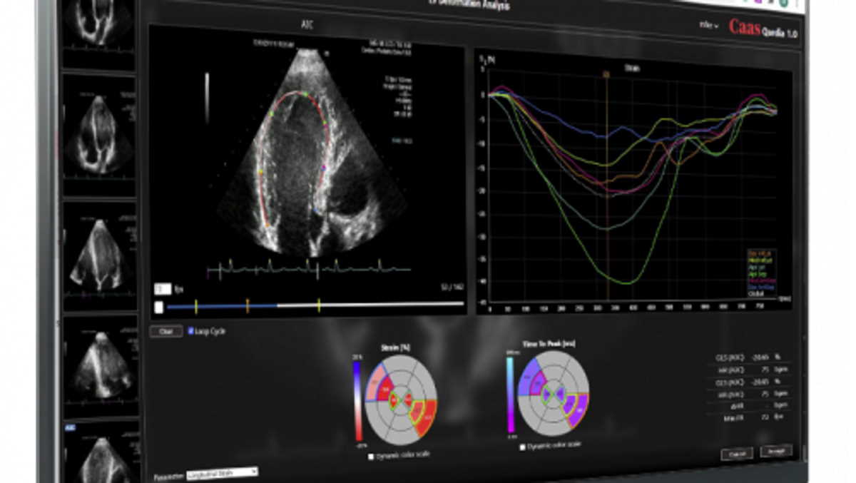 Pie Medical Imaging announces 500th patient in FAST III clinical trial ...