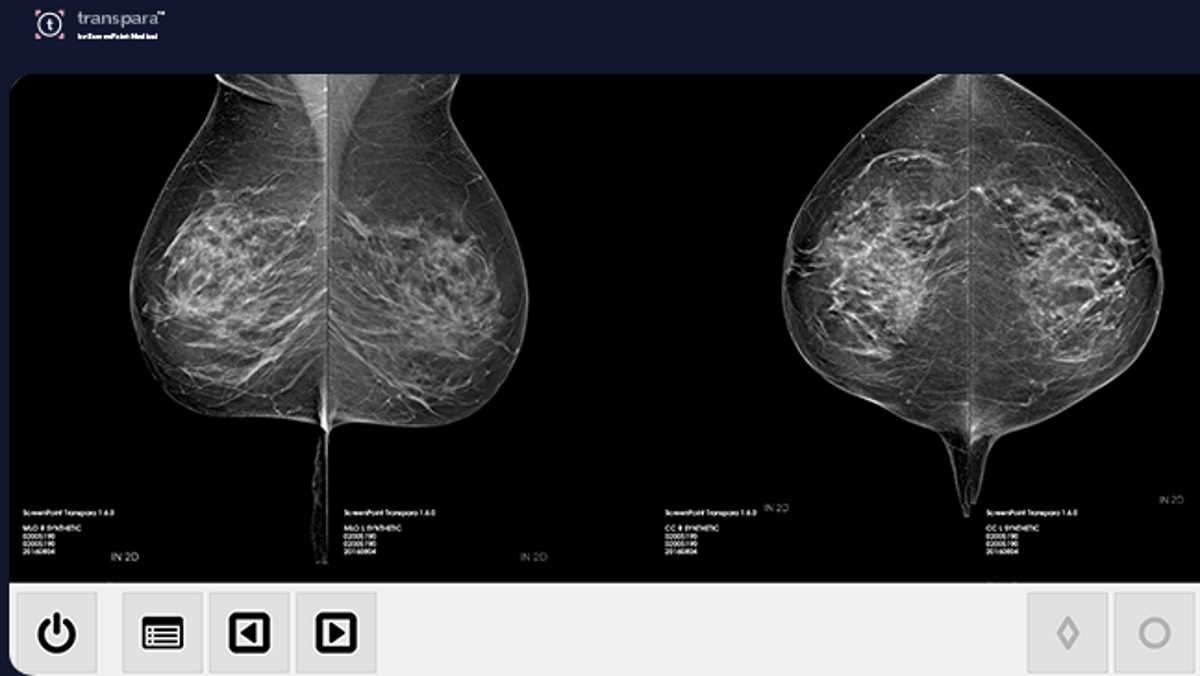 Mayo Clinic and UCSF demonstrates ability to predict long-term breast ...