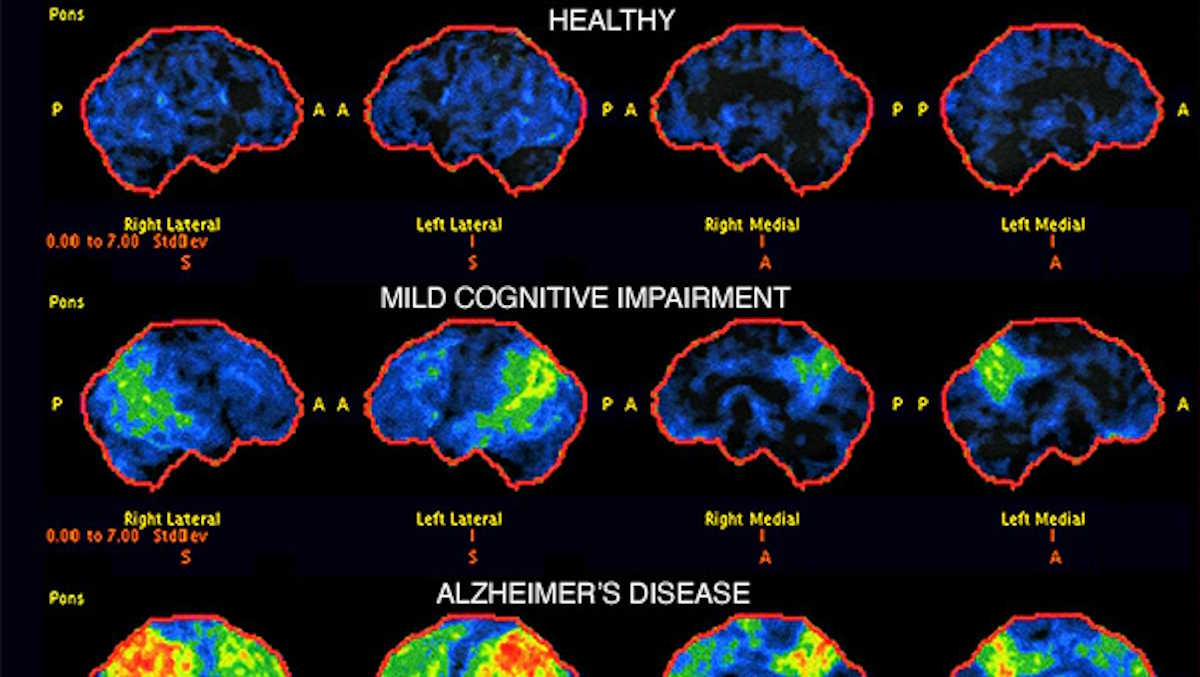 Research team identifies new treatment target for Alzheimer's disease ...