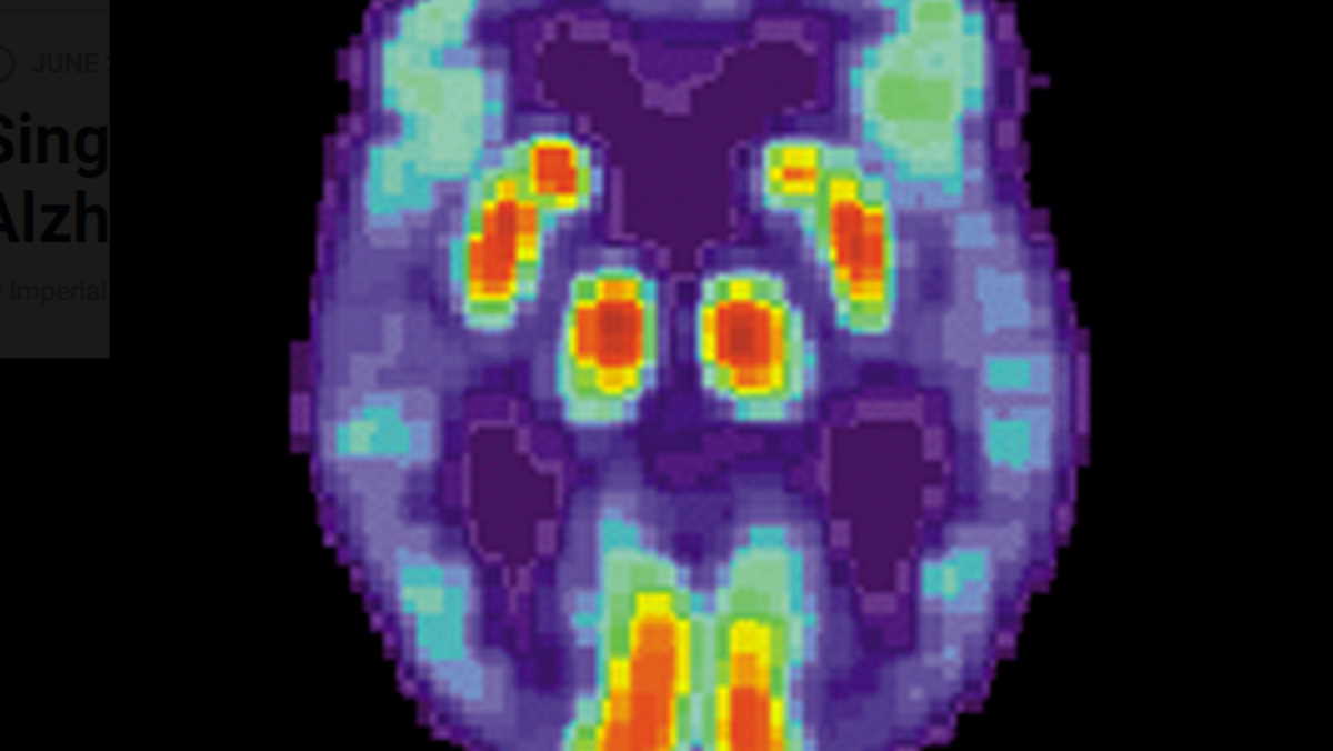 Single brain scan can diagnose Alzheimer's disease | Health | POST ...