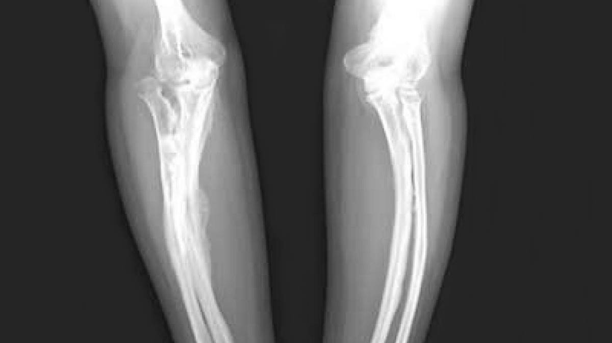 Lifelong genetic disorder osteogenesis imperfecta | Health | POST ...