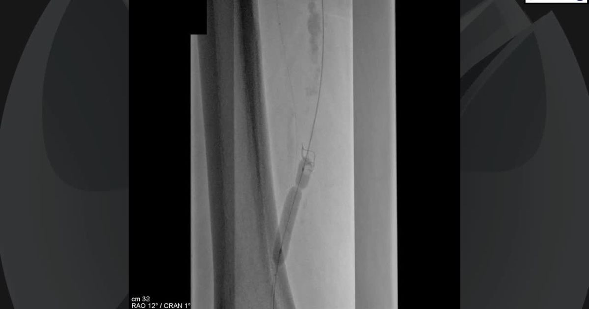 Piper Bypass Ivus Guided Totally Percutaneous Femoral Popliteal