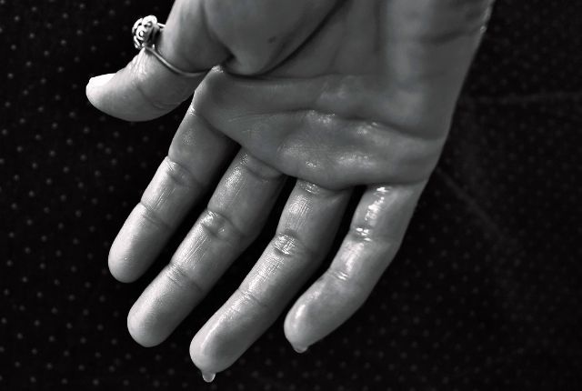 Hyperhidrose ou transpiration excessive : symptômes et traitements | Elsan