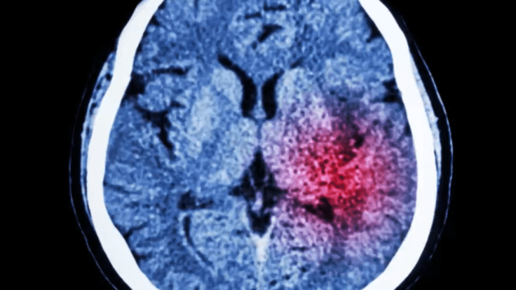 Hypoesthésie : causes, symptômes et traitements de la perte de ...