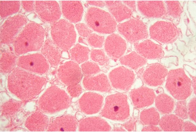 Maladie de Verneuil : Définition, symptômes et traitements ...