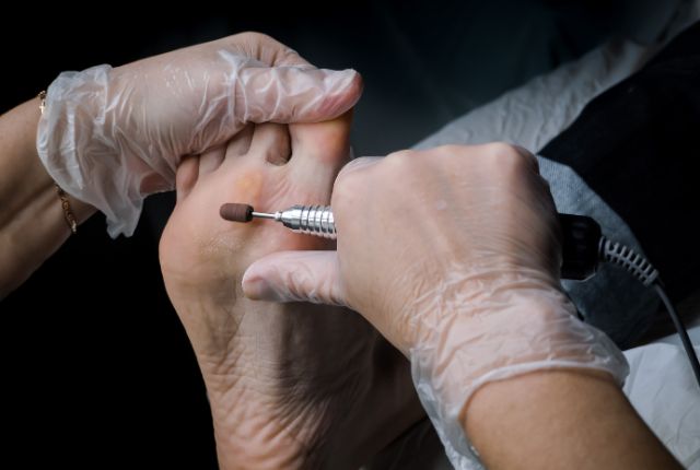 Cor au pied : Symptômes et traitements