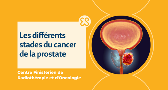Cancer de la prostate stade 2, 3, 4 : Diagnostic et traitement ...