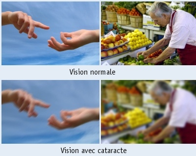 Vous pensez souffrir de cataracte? En connaissez vous les symptômes ...