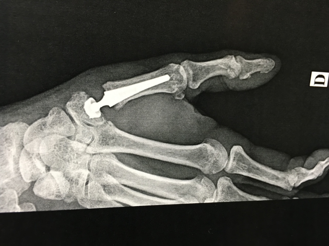 Rhizarthrose, l’arthrose du pouce | Elsan