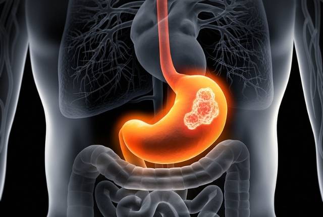Cancer De Lestomac Définition Causes Et Traitement Elsan
