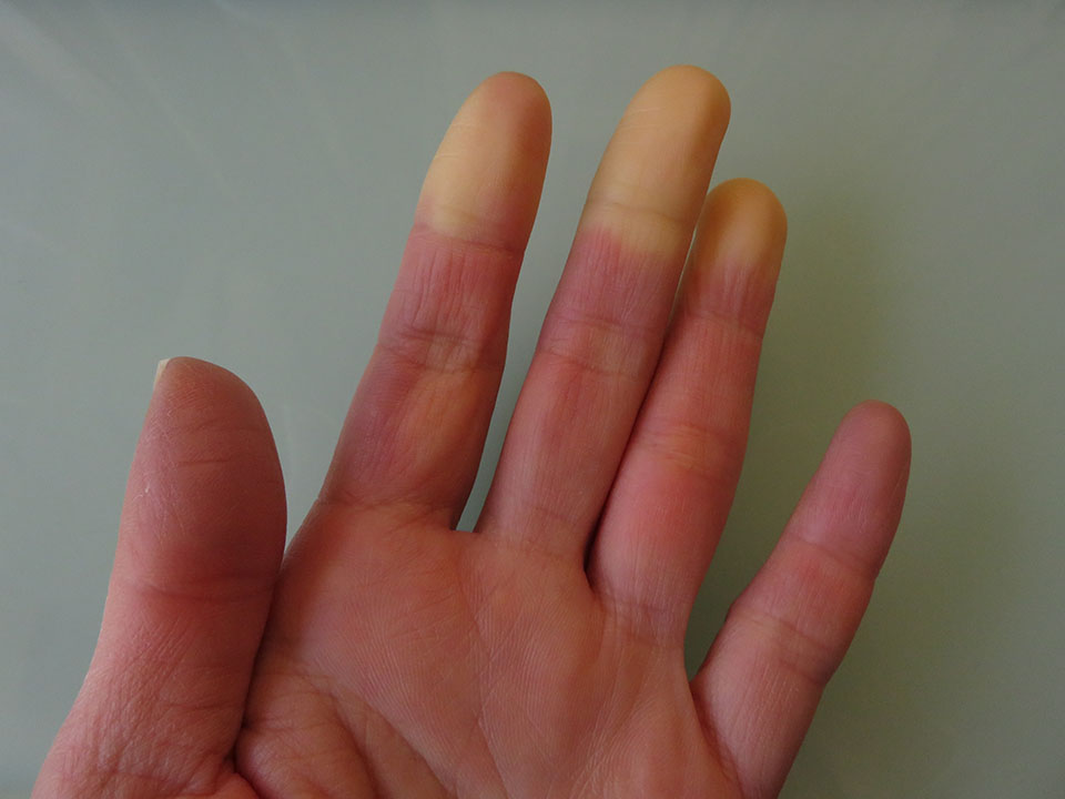 Maladie de Raynaud : définition, causes, traitements | Elsan