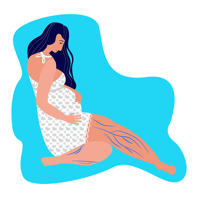 Varices : définition, causes, traitements | Elsan