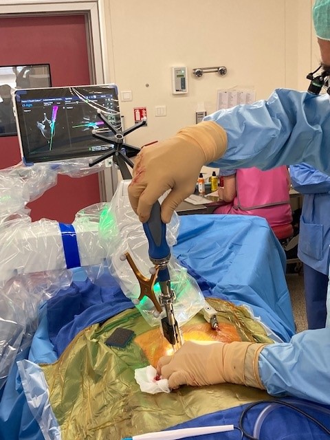 1ers retours d'expérience sur l'utilisation du robot Mazor en chirurgie ...
