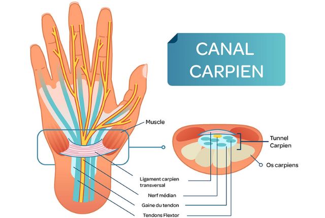 Syndrome du Canal carpien : définition, causes et traitements | Elsan
