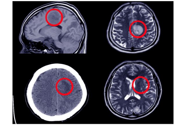 Hydrocéphalie : définition, causes et traitements | Elsan