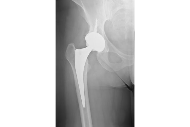 Prothèse totale de hanche : définition, pose et suite | Elsan