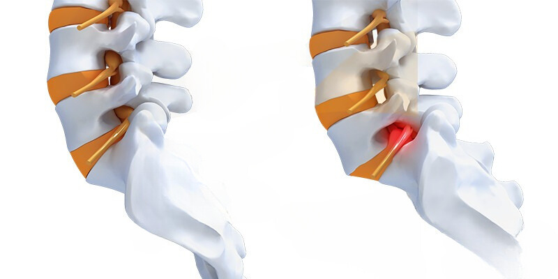 Le spondylolisthésis | Clinique d'Occitanie Elsan