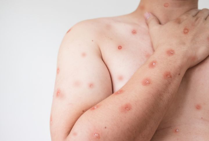 Mpox : alerte de l’OMS et nouveau variant de la variole du singe | ELSAN Actualités