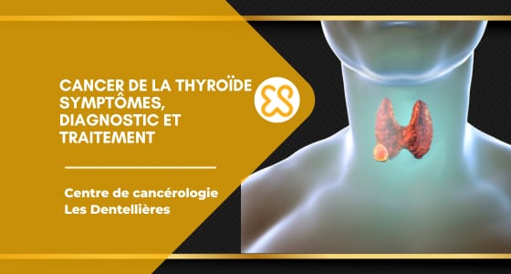 Cancer de la thyroïde – Symptômes, diagnostic et traitement