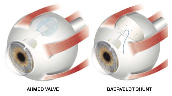 glaucoma valve and shunt | Wills Eye Hospital