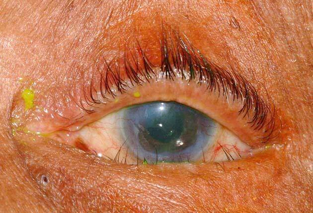 entropion2 | Wills Eye Hospital