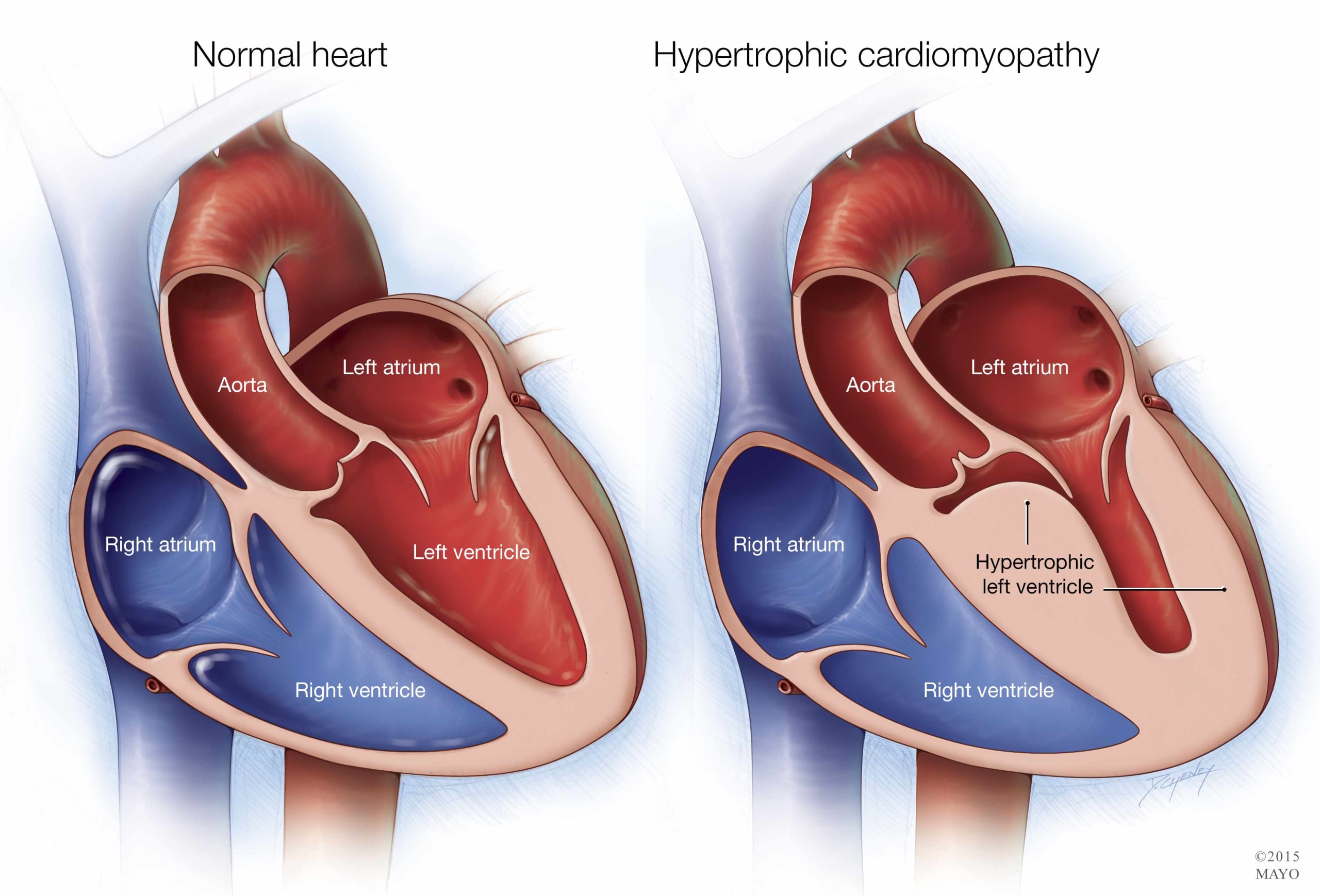 Miocardiopatia Conheca Os Varios Tipos Deste Disturbio Cardiaco Images