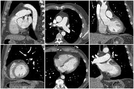 Comment interpréter les scanners CT cardiaques : 3 Méthodes Essentielles