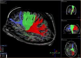 How to Interpret Diffusion Tensor Imaging: 3 Essential Techniques