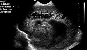 How to interpret Neonatal Cranial Ultrasound: 3 Key Aspects