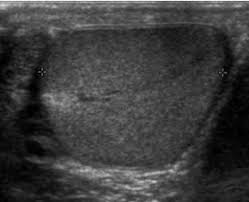How to interpret scrotal ultrasounds: 3 Essential Methods
