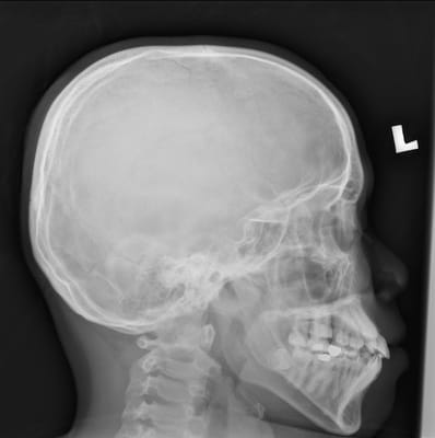 X Ray Head X Ray Image Of The Skull From The Back. X Ray Of A Man S