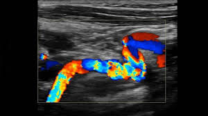 How to Interpret Vascular Ultrasounds: 3 Simple Methods