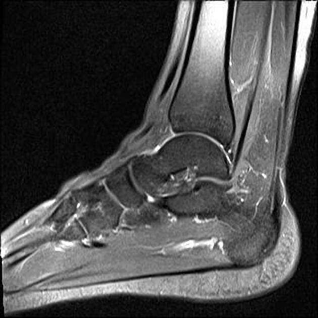 Understanding the Anterior Talofibular Ligament (ATFL)