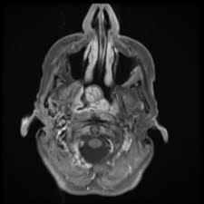 Understanding Exophytic Growths