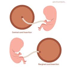 What Is Marginal Cord Insertion?