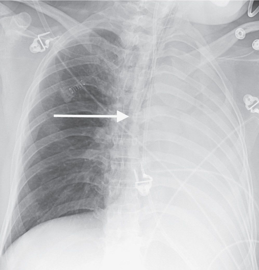 Normal vs. Abnormal Chest X-Rays: What Do They Reveal?