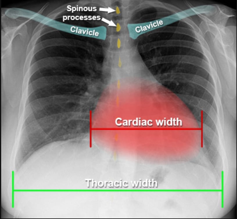 Normal vs. Abnormal Chest X-Rays: What Do They Reveal?