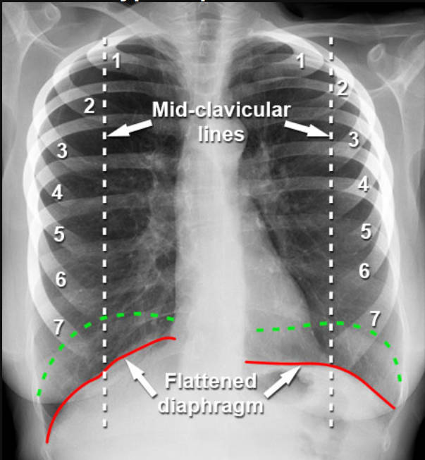 Normal vs. Abnormal Chest X-Rays: What Do They Reveal?