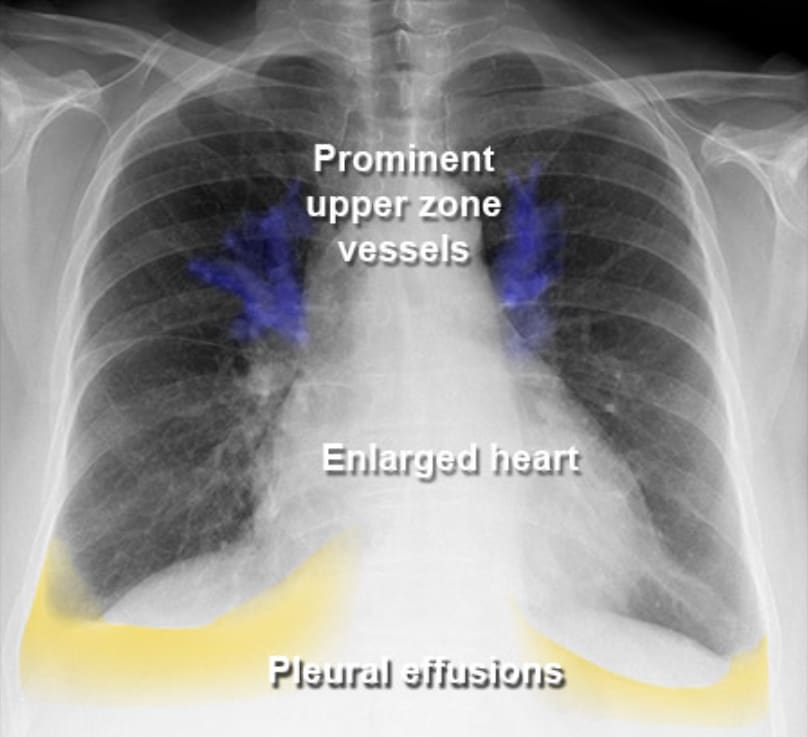 Normal vs. Abnormal Chest X-Rays: What Do They Reveal?